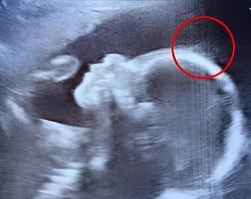 Doctors couldn’t believe what they saw during the ultrasound ...